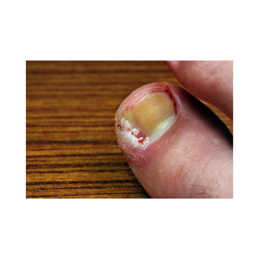 Ingrown Toenail Causes and Solutions - Waikato Podiatry