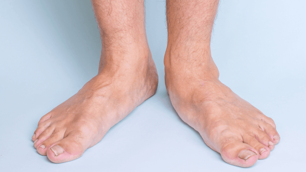 Posterior Tibial Tendon Dysfunction (PTTD) - Waikato Podiatry