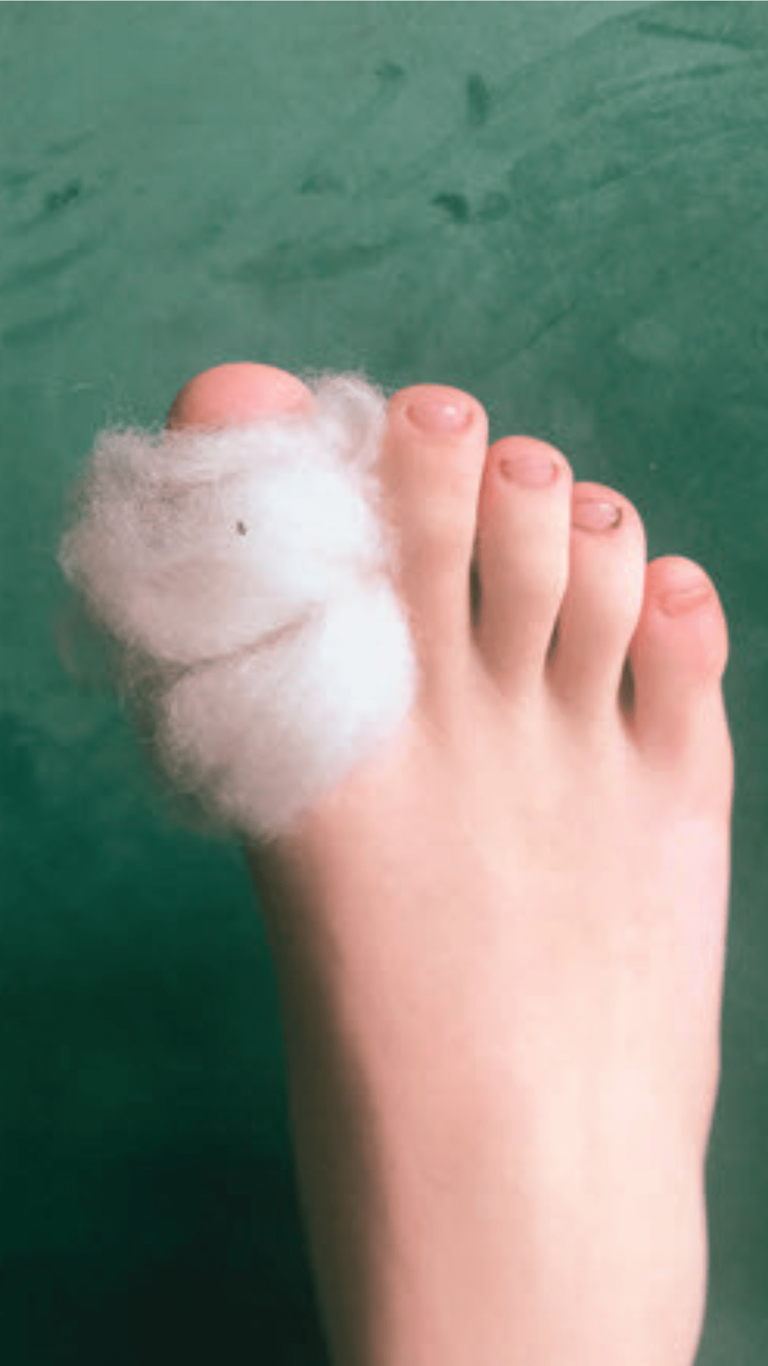 What is Hiker’s Wool? - Waikato Podiatry