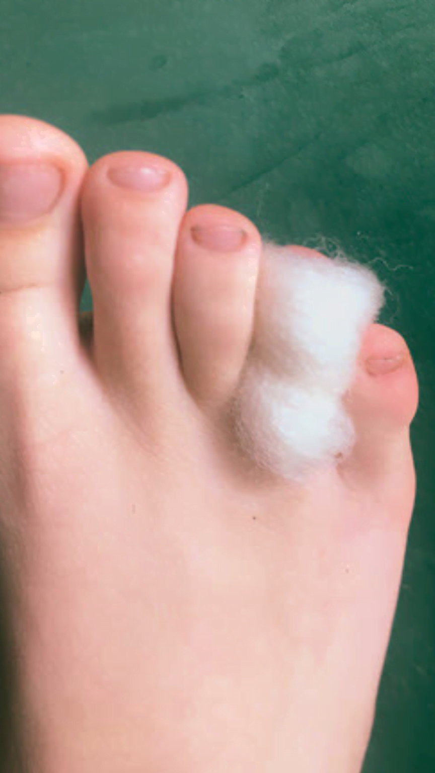 What is Hiker’s Wool? - Waikato Podiatry
